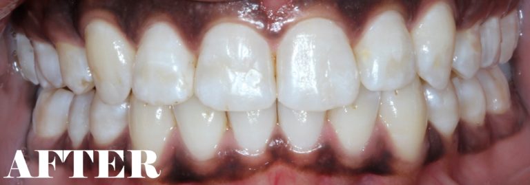 Flared Teeth Corrected - MYNT Dental Winnipeg